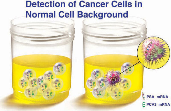 USRF - PCA3: A Genetic Marker of Prostate Cancer